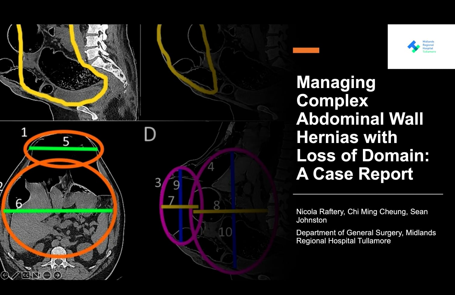 Managing Complex Abdominal Wall Hernias with Loss of Domain on Vimeo