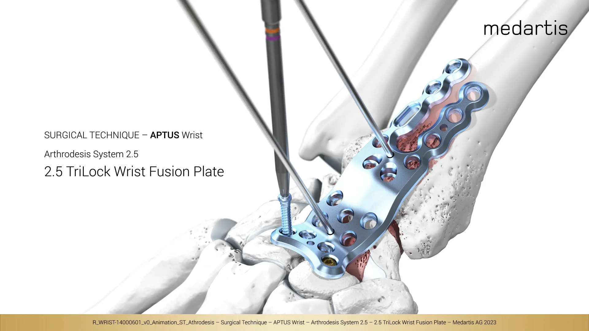 Surgical Animation Total Wrist Fusion Plate Medartis on Vimeo