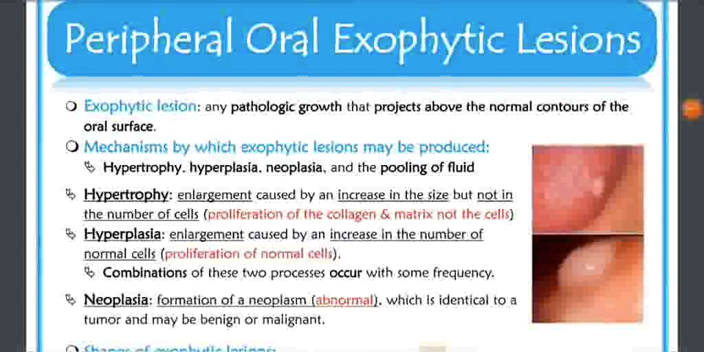 Peripheral oral exophytic lesions I on Vimeo