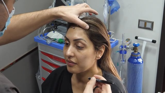 Sandeep Samra's Hair Journey - Hair line drawing Female FUE – Este ...