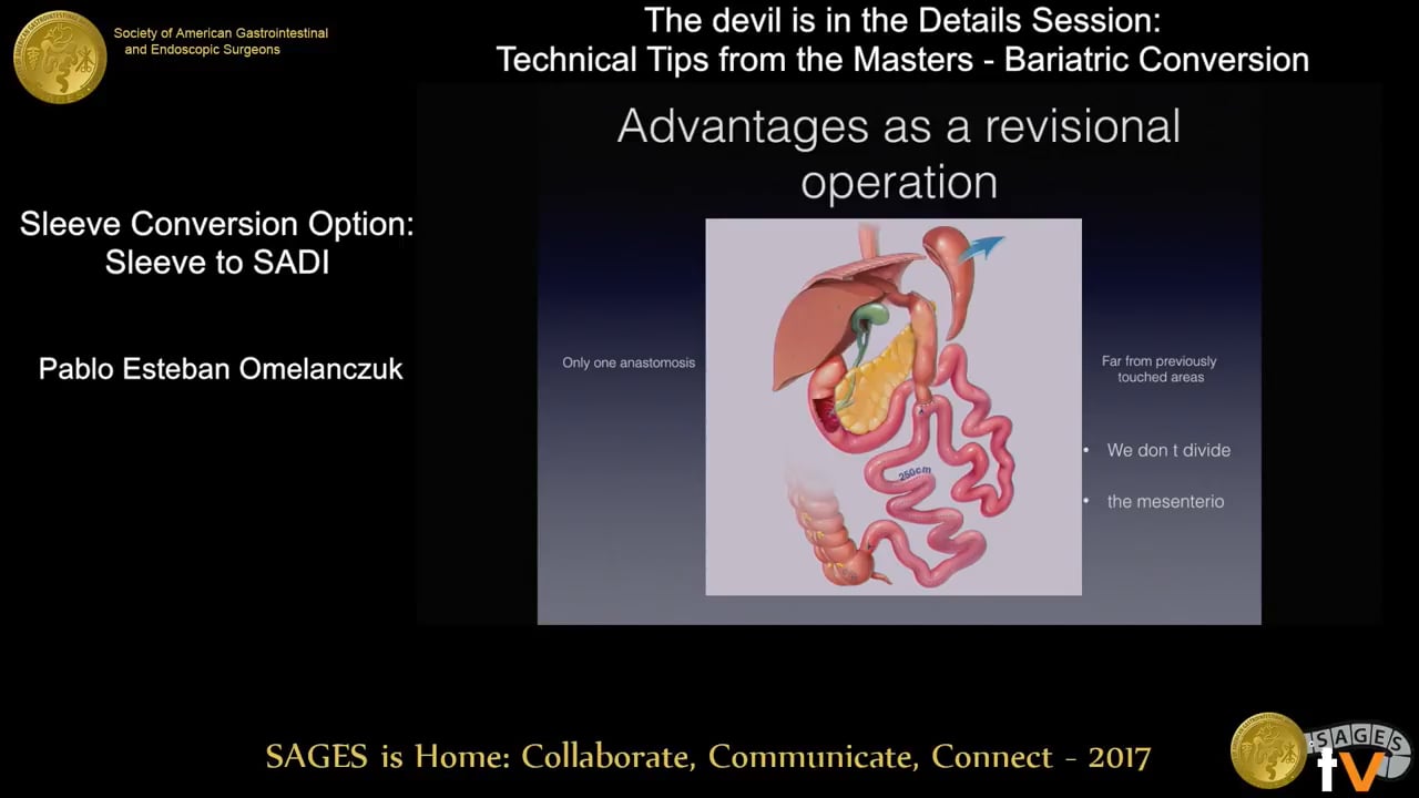 Sleeve conversion to SADI on Vimeo