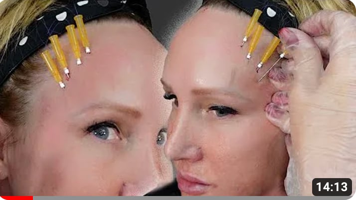 Cog Thread Brow Lift // Gorgeously Aging Advanced on Vimeo