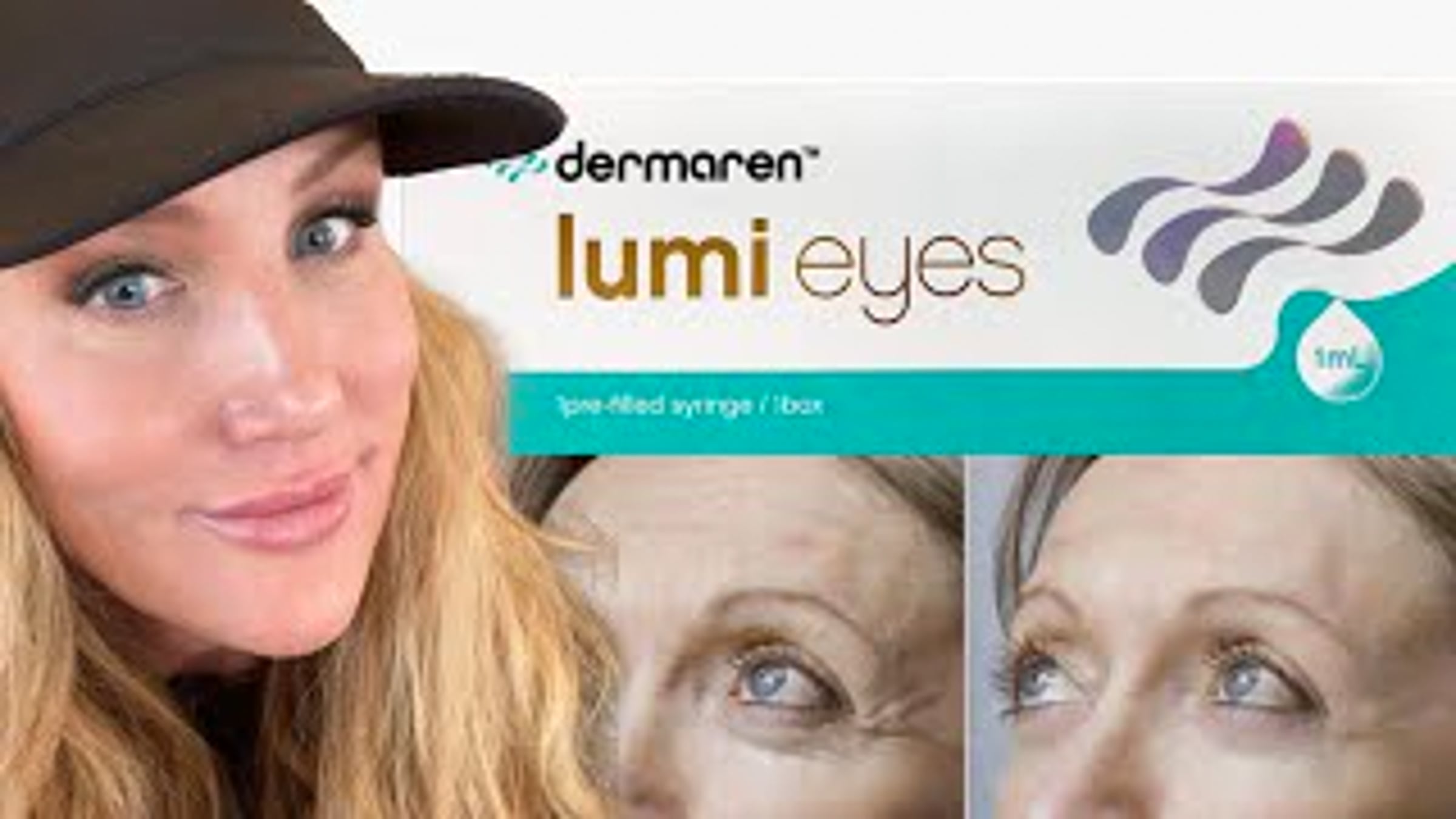 Lumi Eyes PDRN for Under Eye Rejuvenation // Mesotherapy