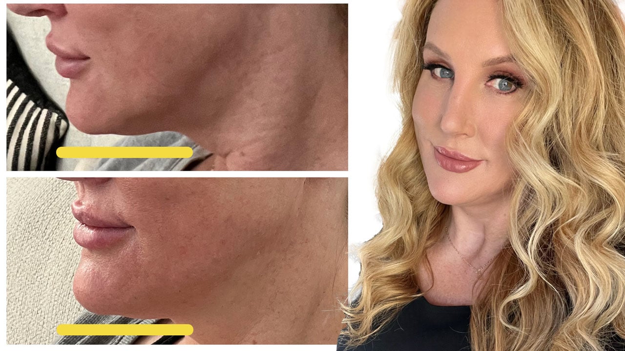 Facial Fat Dissolving Treatment 4 - Dr. Lipo V - Tips for Tightening ...