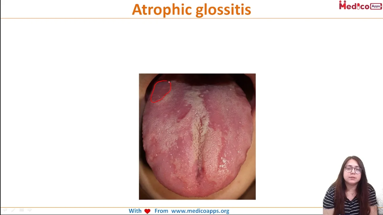 Atrophic glossitis on Vimeo