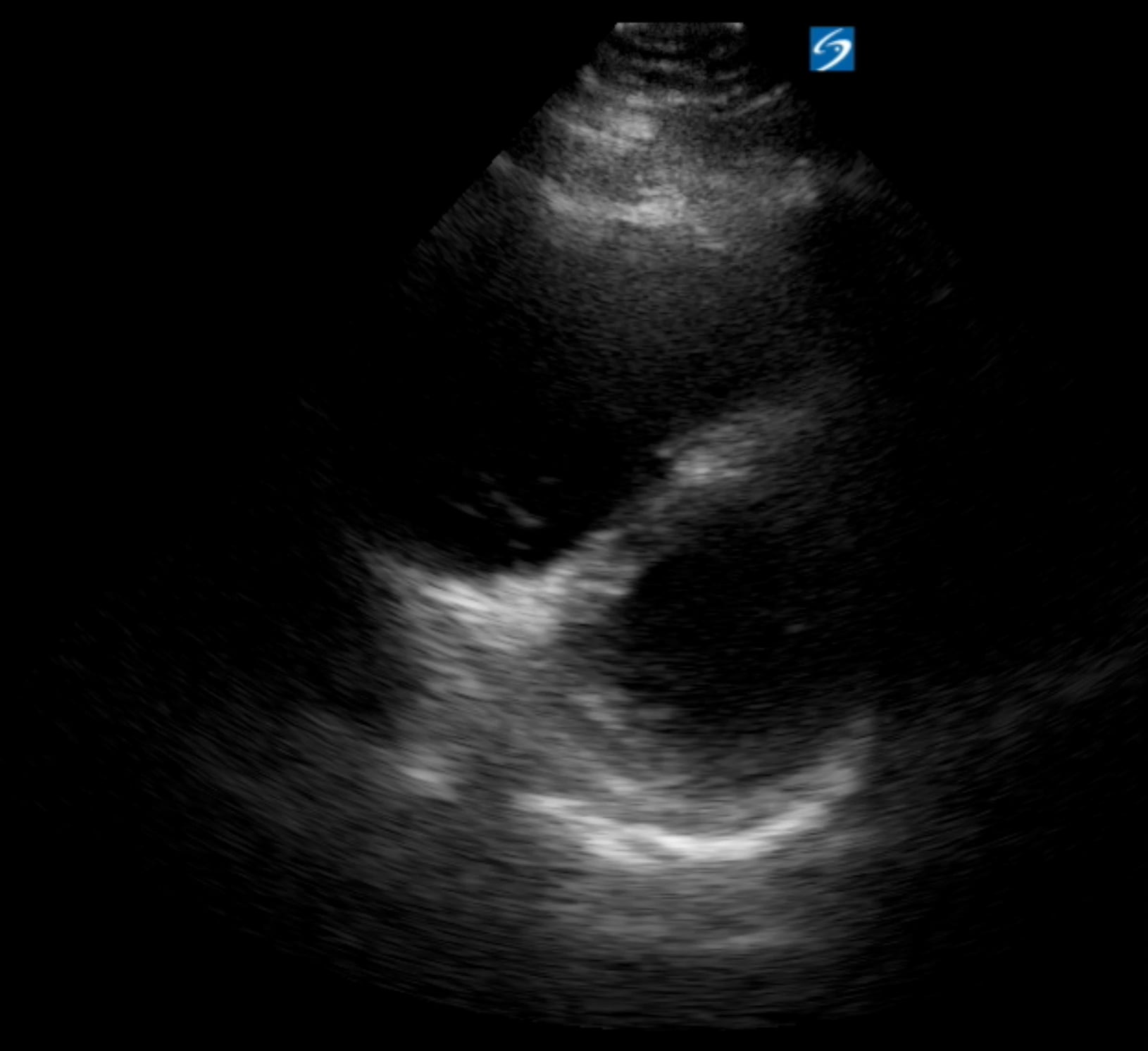 PSAx: dilated RV, D shaped LV on Vimeo