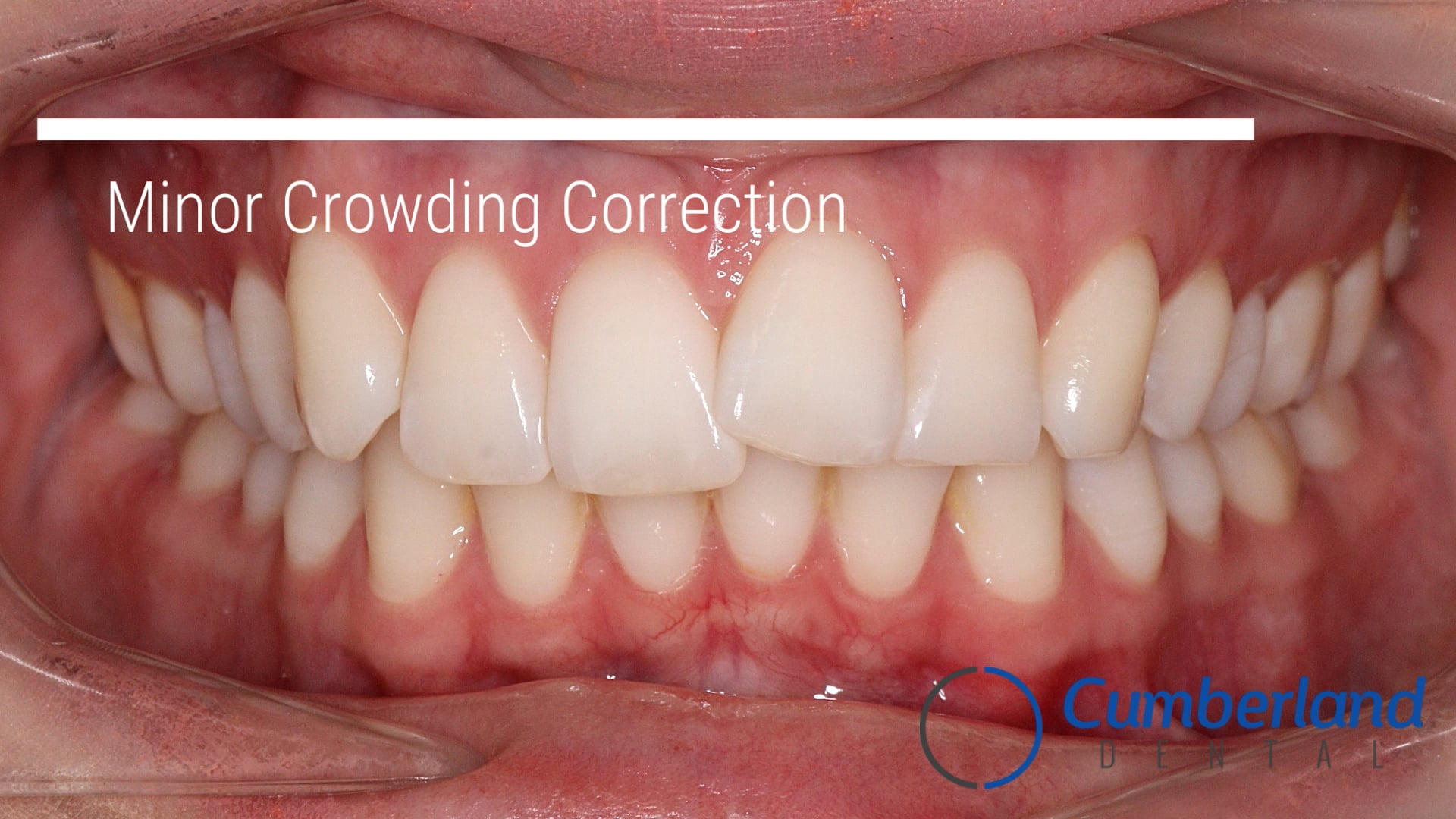 Solve Minor Crowding With Invisalign on Vimeo