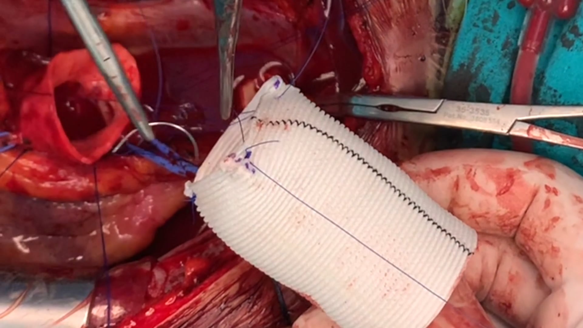 A new alternative to the Bentall procedure: aortic valve ...