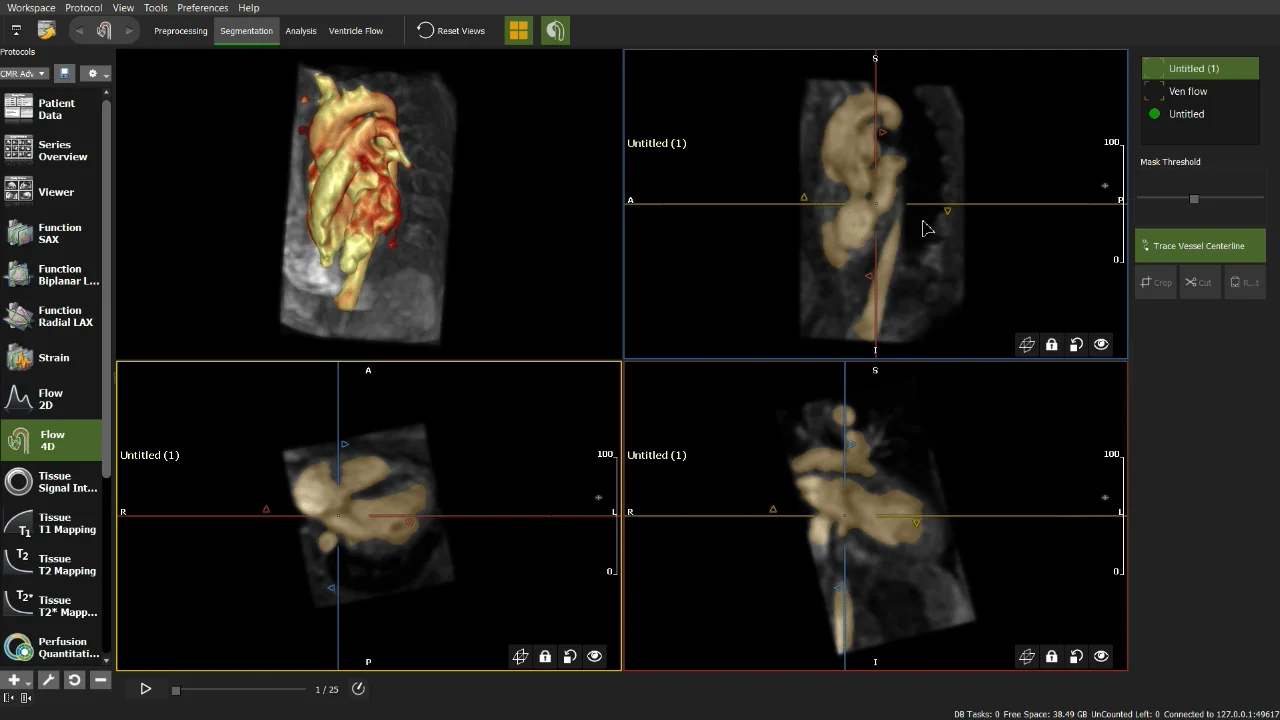 cvi42 4D Flow gif on Vimeo