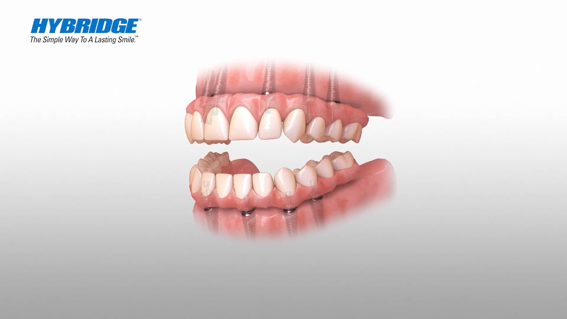 What is a Hybridge Full Mouth Dental Implant Restoration? on Vimeo