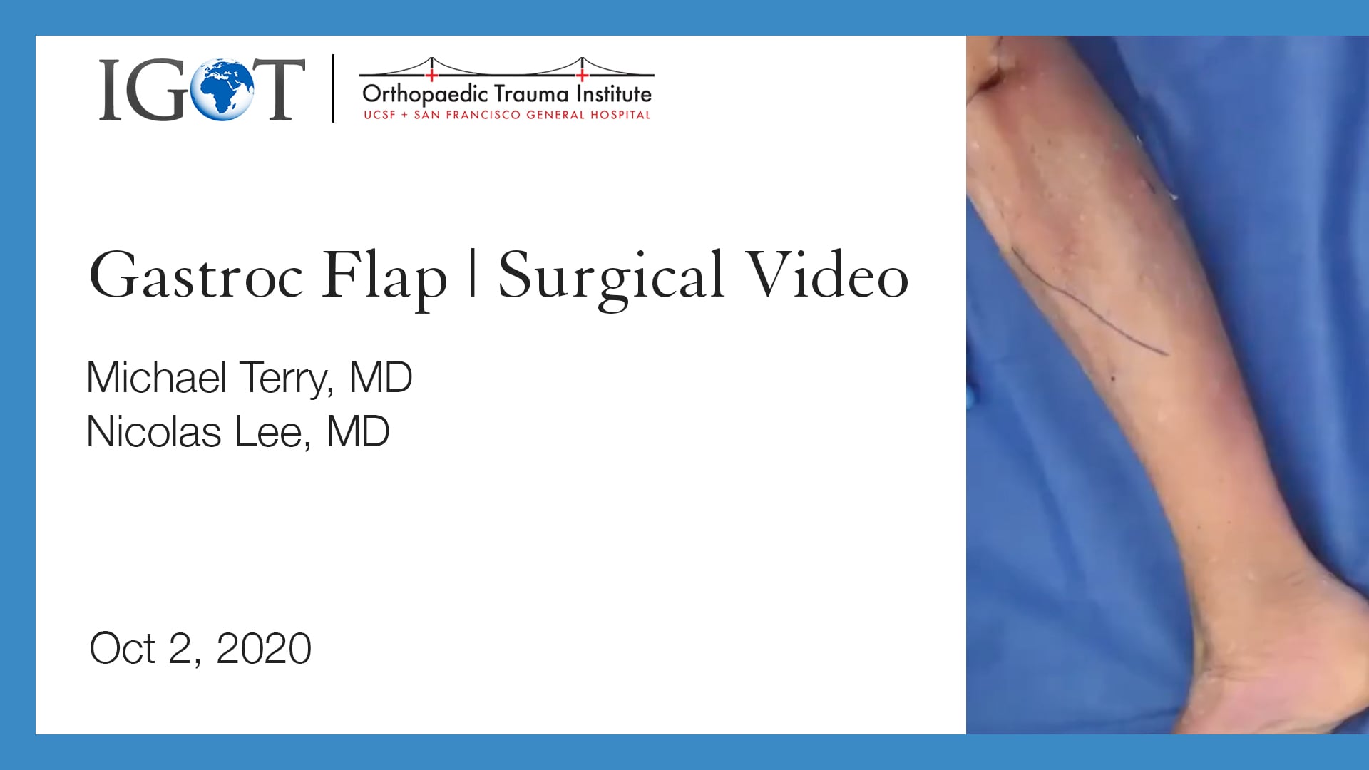 Gastroc Flap on Vimeo