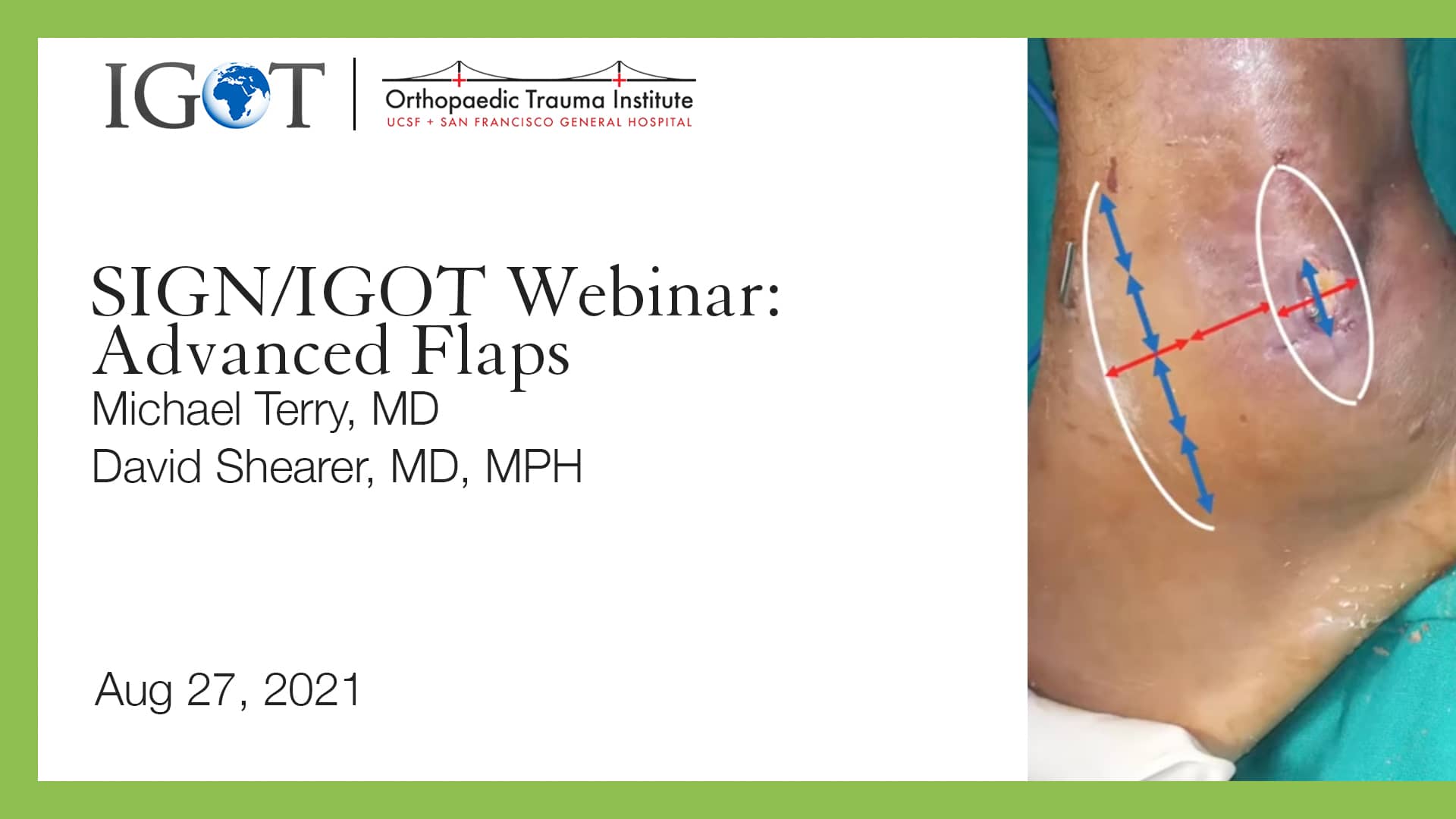 SIGN IGOT Advanced Flaps Webinar (8 27 21) on Vimeo