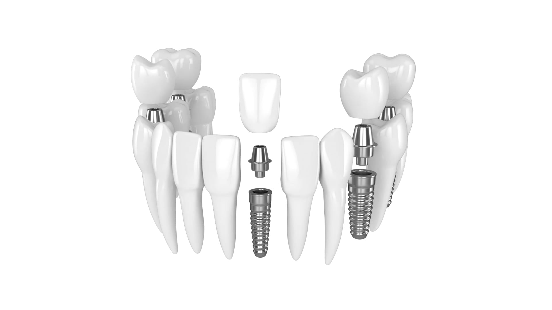 MV01_The Science of Dental Implants_Dr Bain on Vimeo