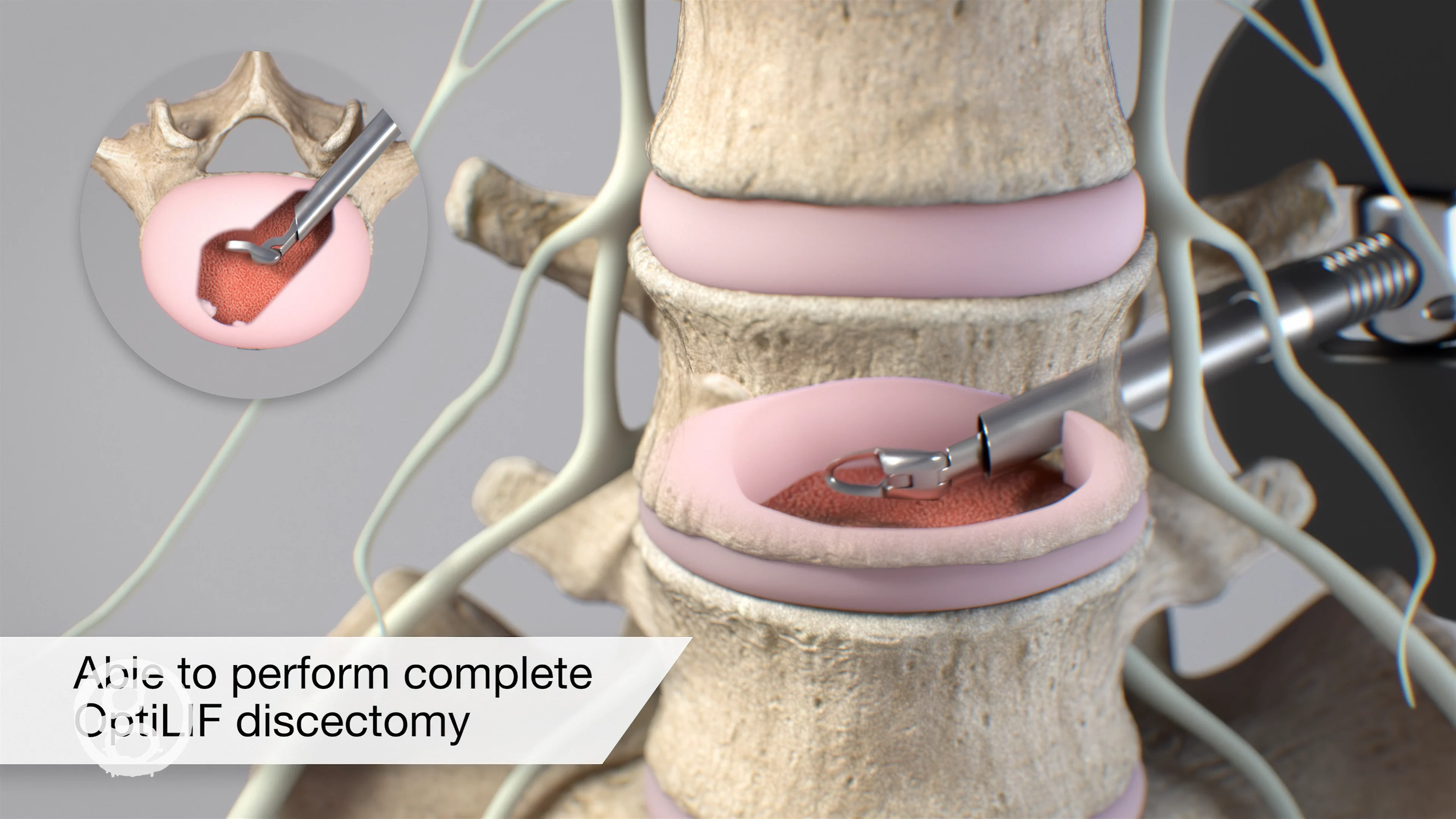 Spineology - OptiLIF® Endo System - Ultra-Minimally Invasive Spine ...
