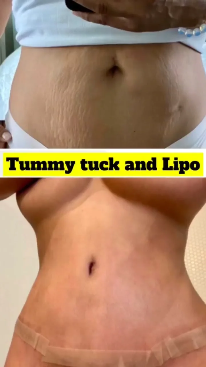 Tummy Tuck and liposuction transformation by Dr 6ix on Vimeo