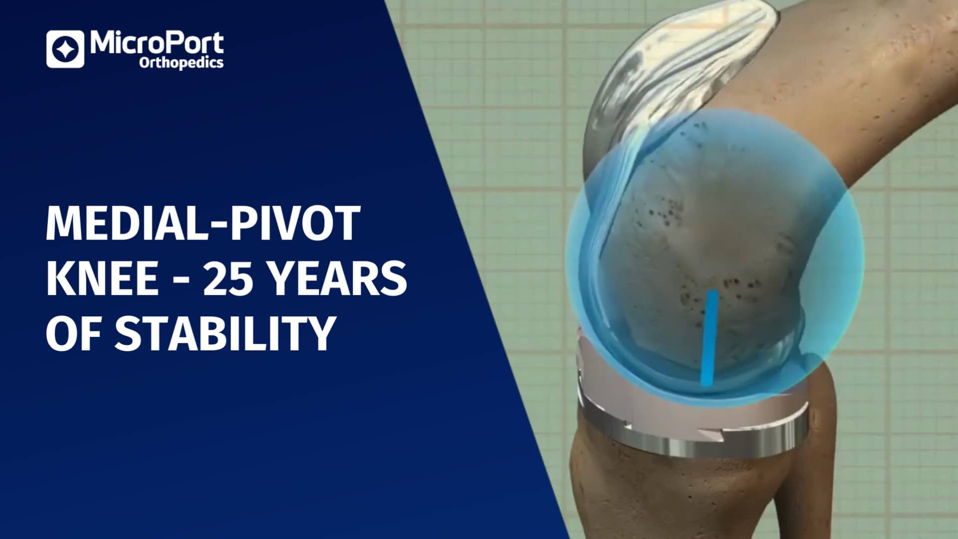 Medial-Pivot Knee - 25 Years of Stability on Vimeo