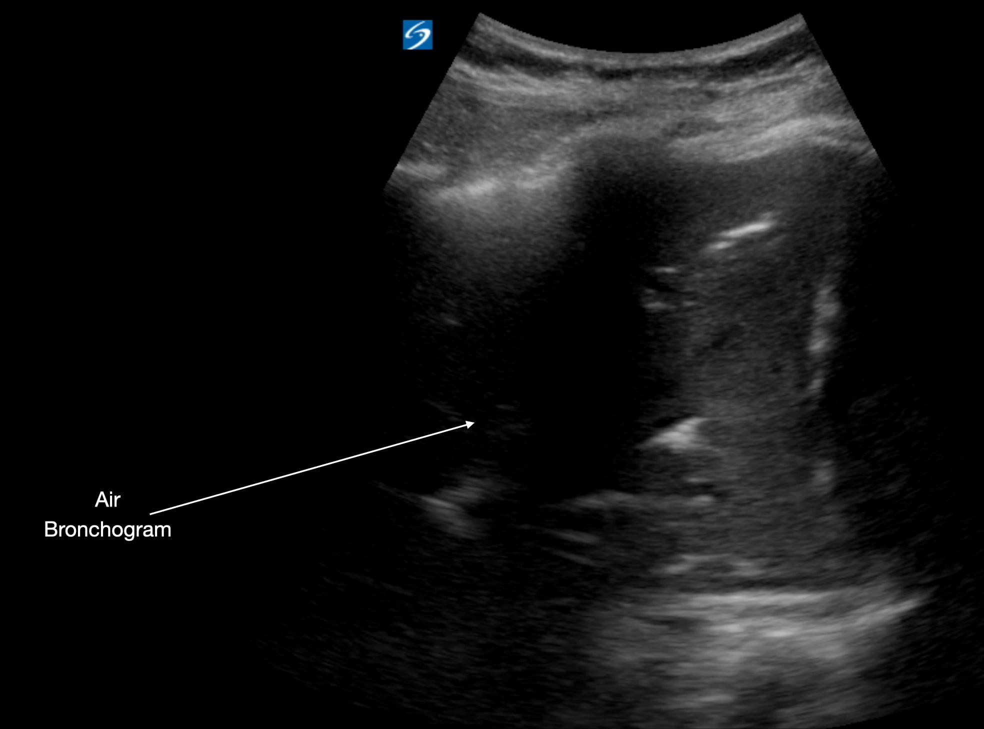 Consolidation + Air Bronchograms on Vimeo