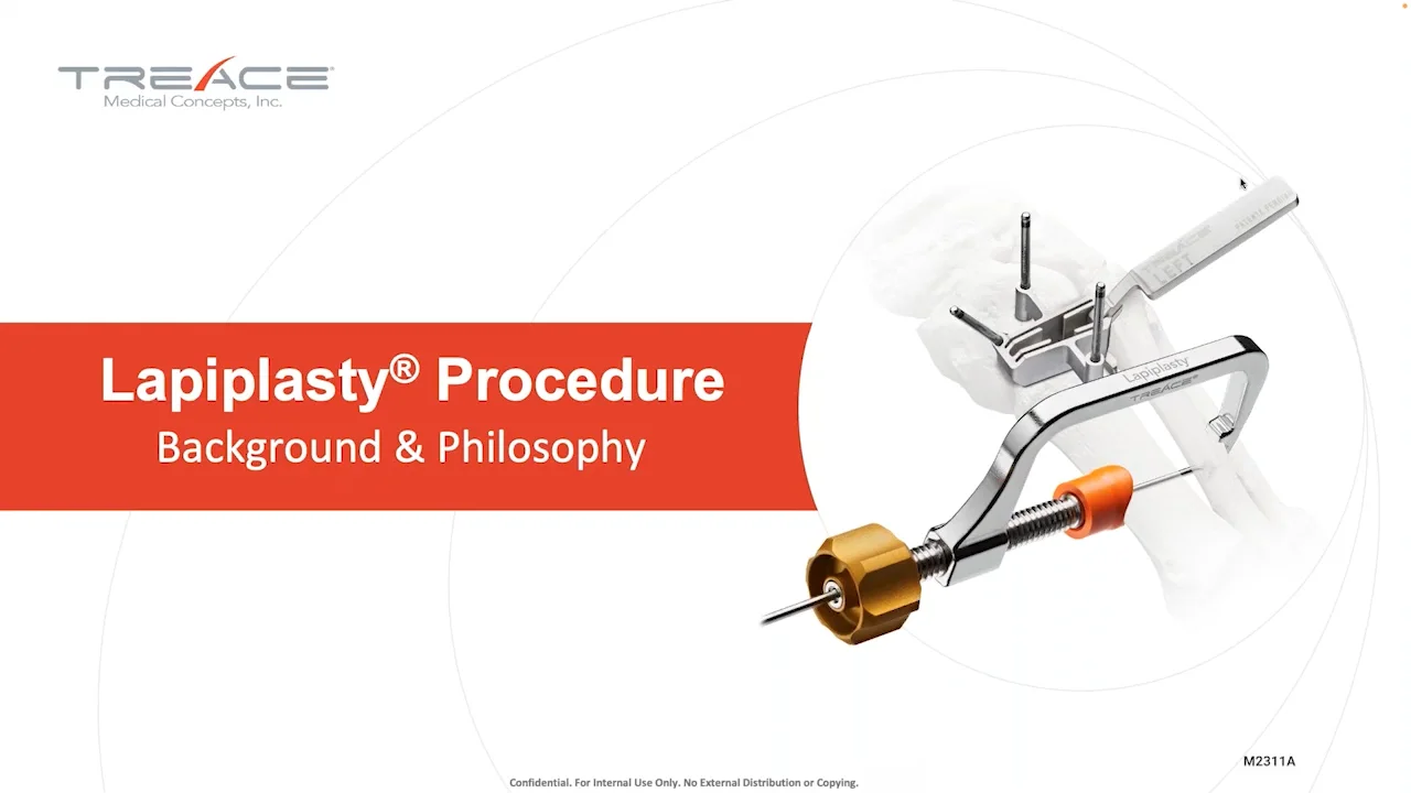 Lapiplasty® System Overview Dr. Paul Dayton on Vimeo