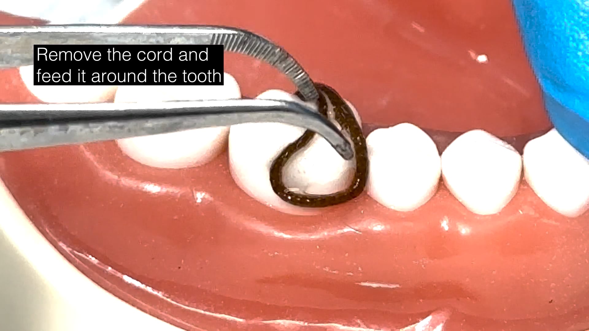 How To Place A Retraction Cord on Vimeo