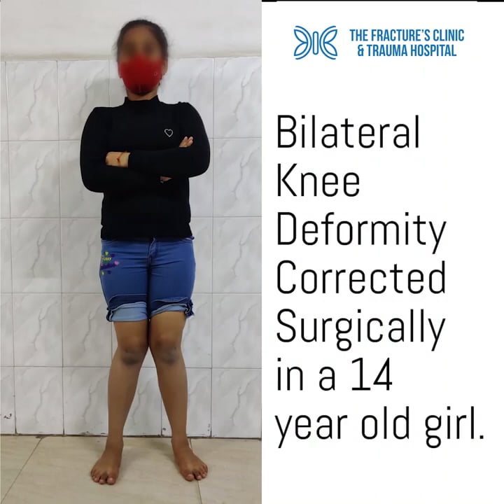 bilateral knee defect surgery-Dr Abhinav Kr Agrawal on Vimeo