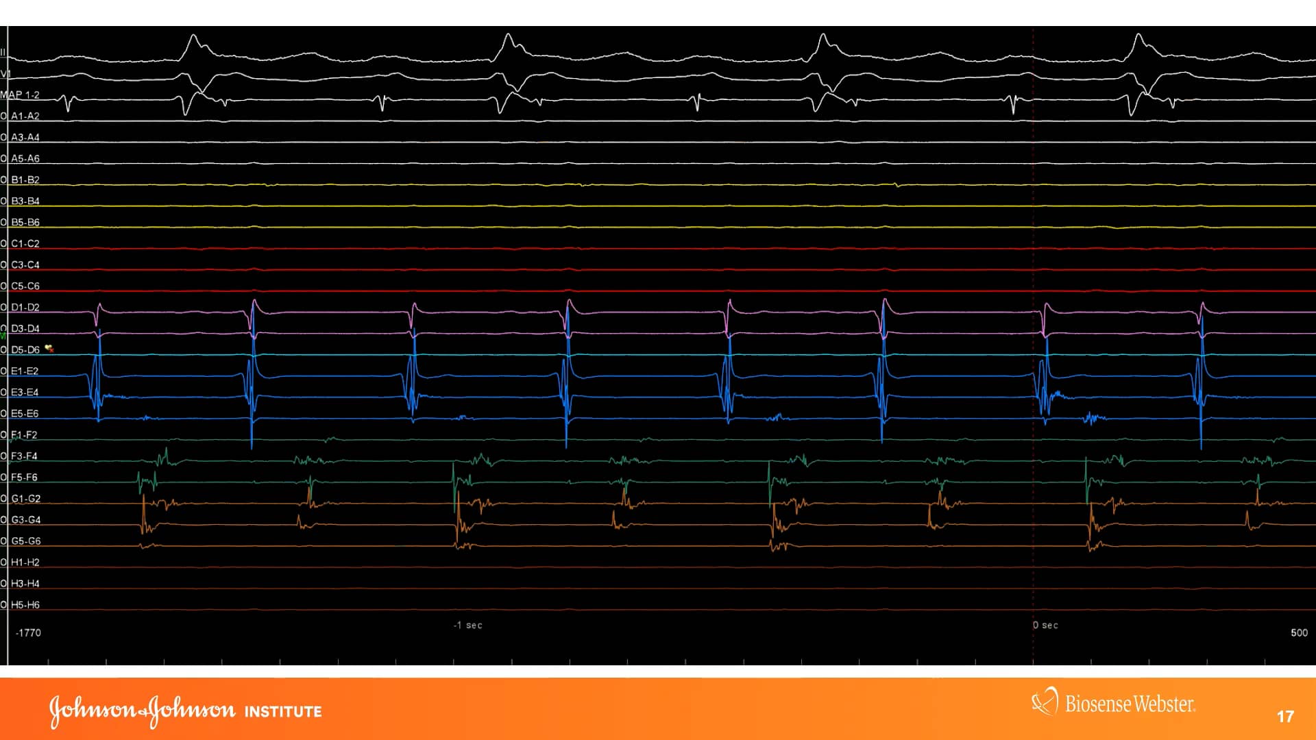 OCTARAY Mapping Catheter With TRUEref Technology - J&J -2022-09-06 on Vimeo
