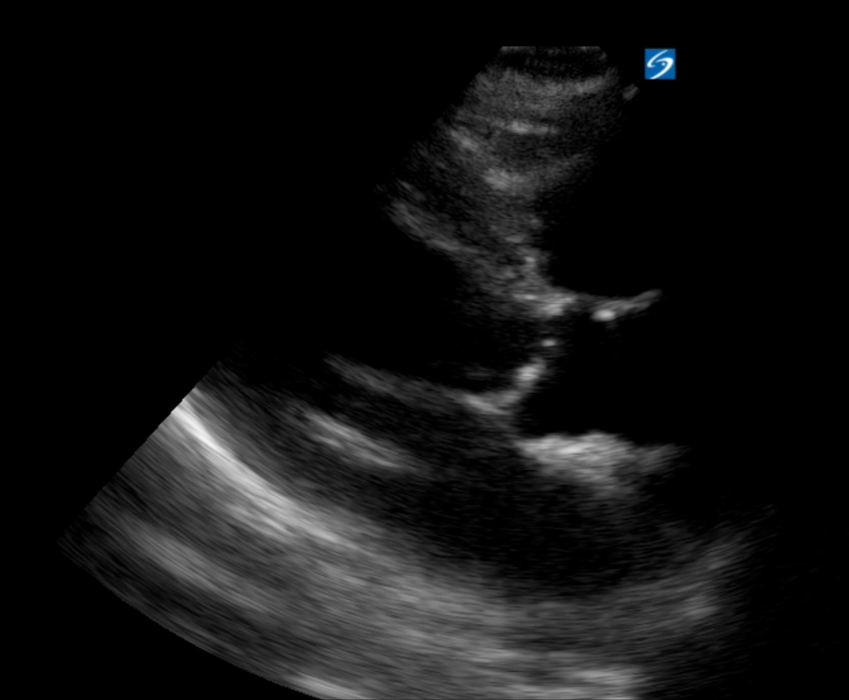 PLAx - LV hypertrophy and dilated LA on Vimeo