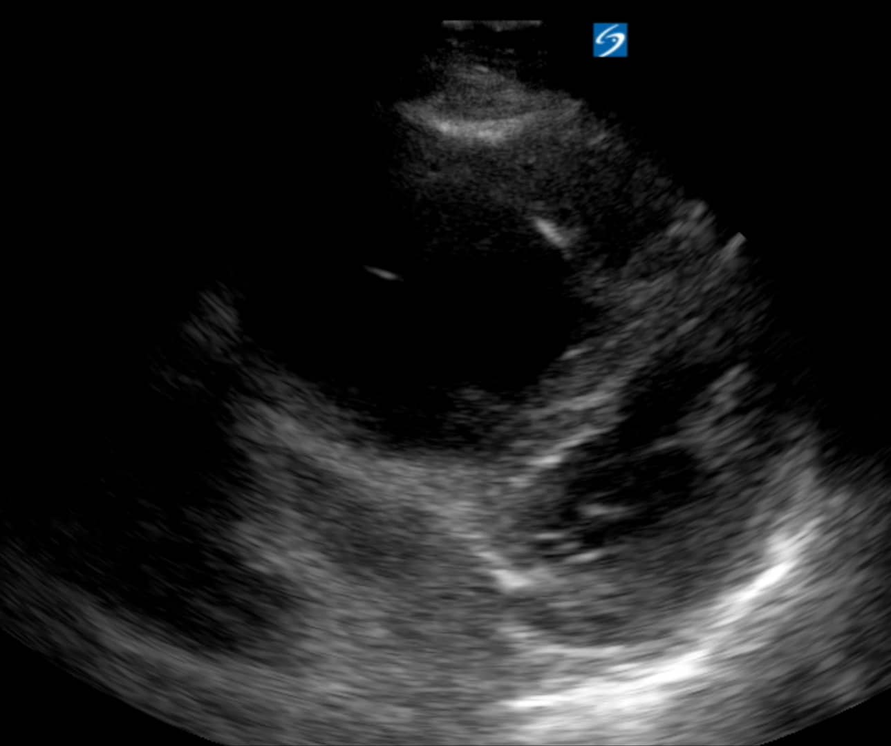 PSAx - chronic RV dysfunction on Vimeo
