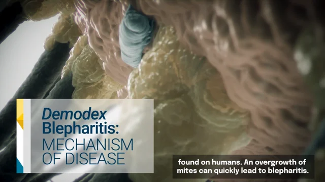 Demodex Blepharitis