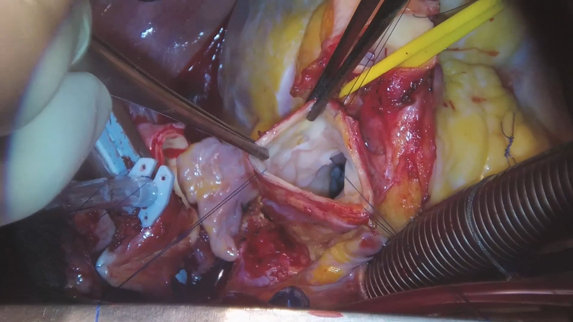 Resection and double pericardial patch repair of a congenital aneurysm ...