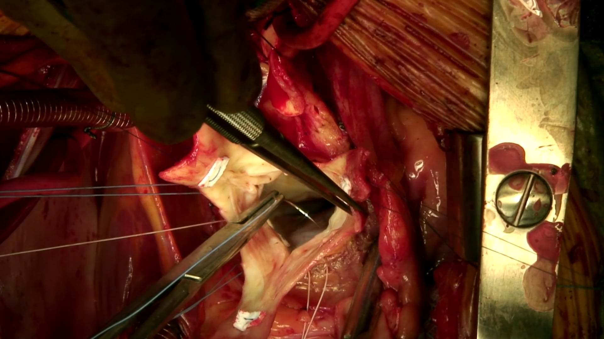 Valve-sparing root reimplantation with a Valsalva graft for a ...