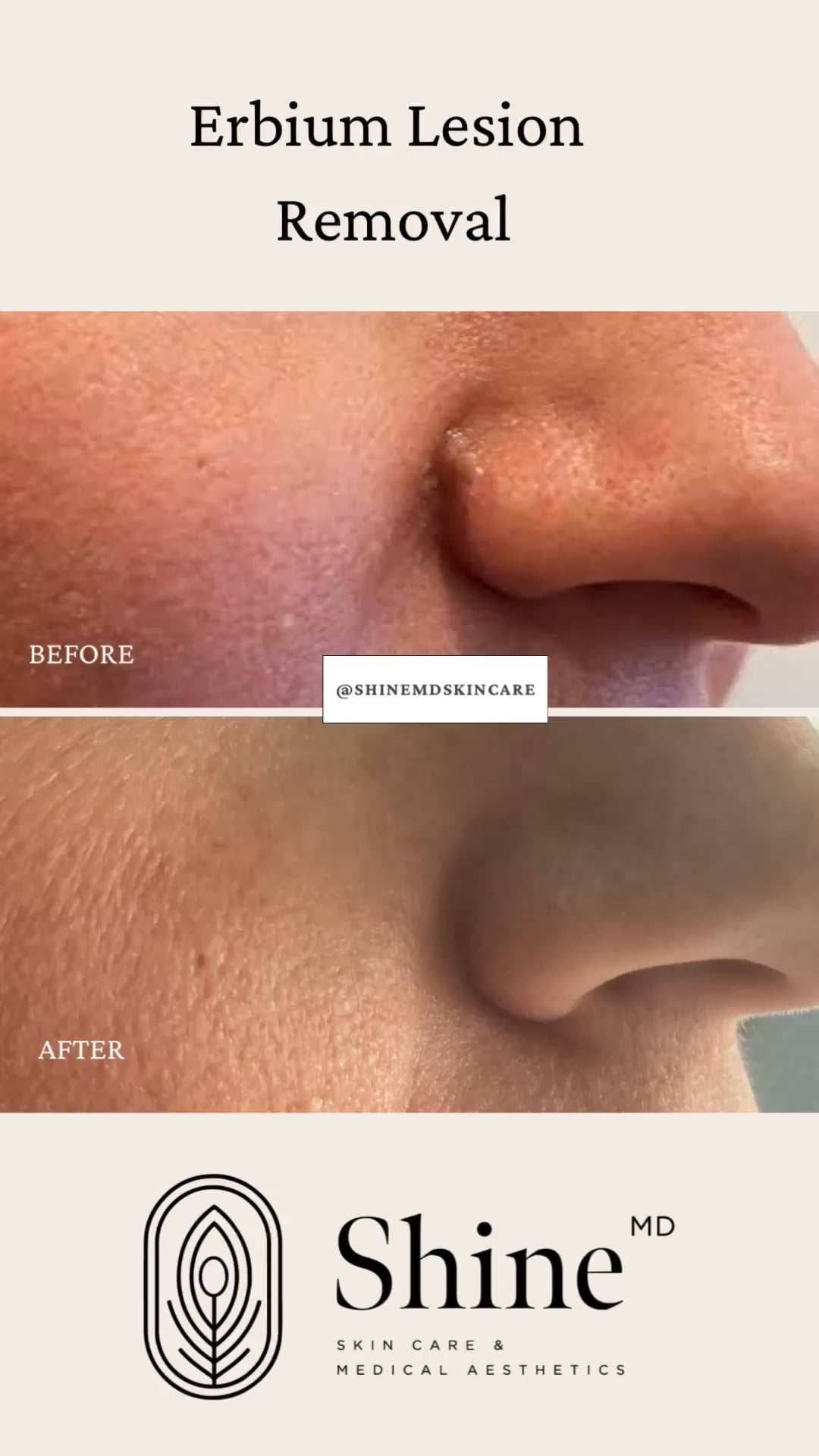 Skin Lesions - Moles, Skin Tags, Seborrheic Keratoses, Sebaceous ...