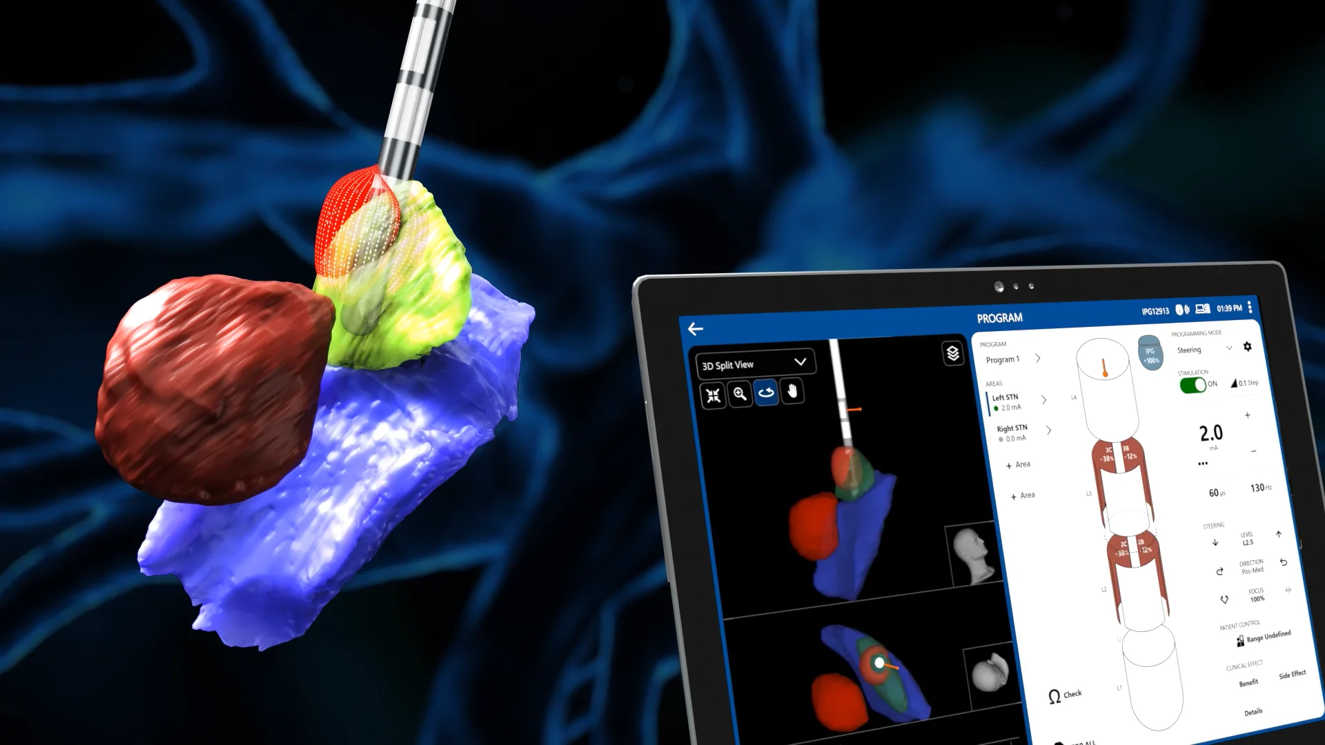 Boston Scientific’s next innovation in Image Guided Programming, Vercise™ Neural Navigator 5 ...