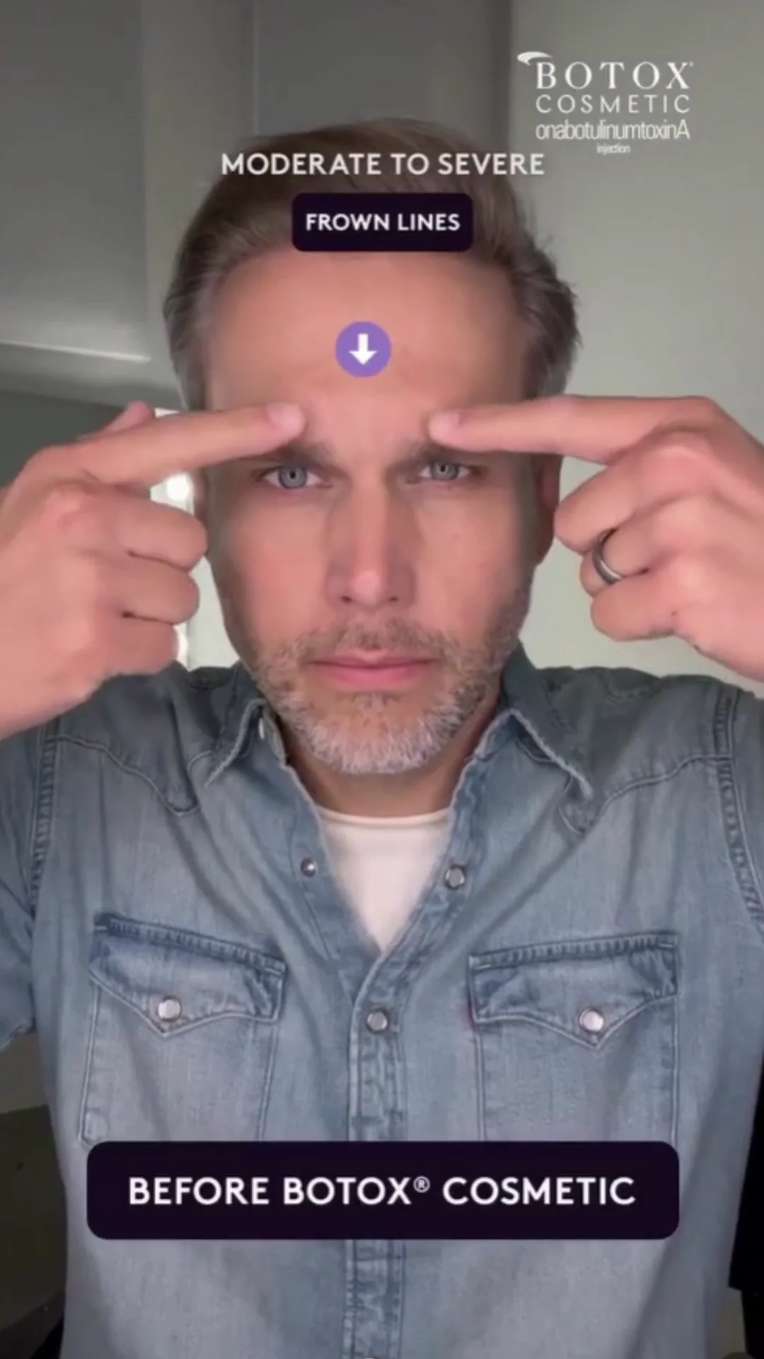 Male Botox - Male Botox Injection Sites on Vimeo