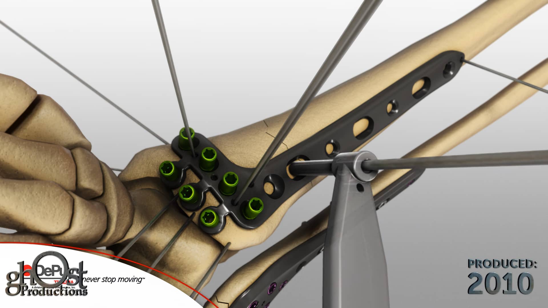 Depuy Distal Tibia Plating System on Vimeo
