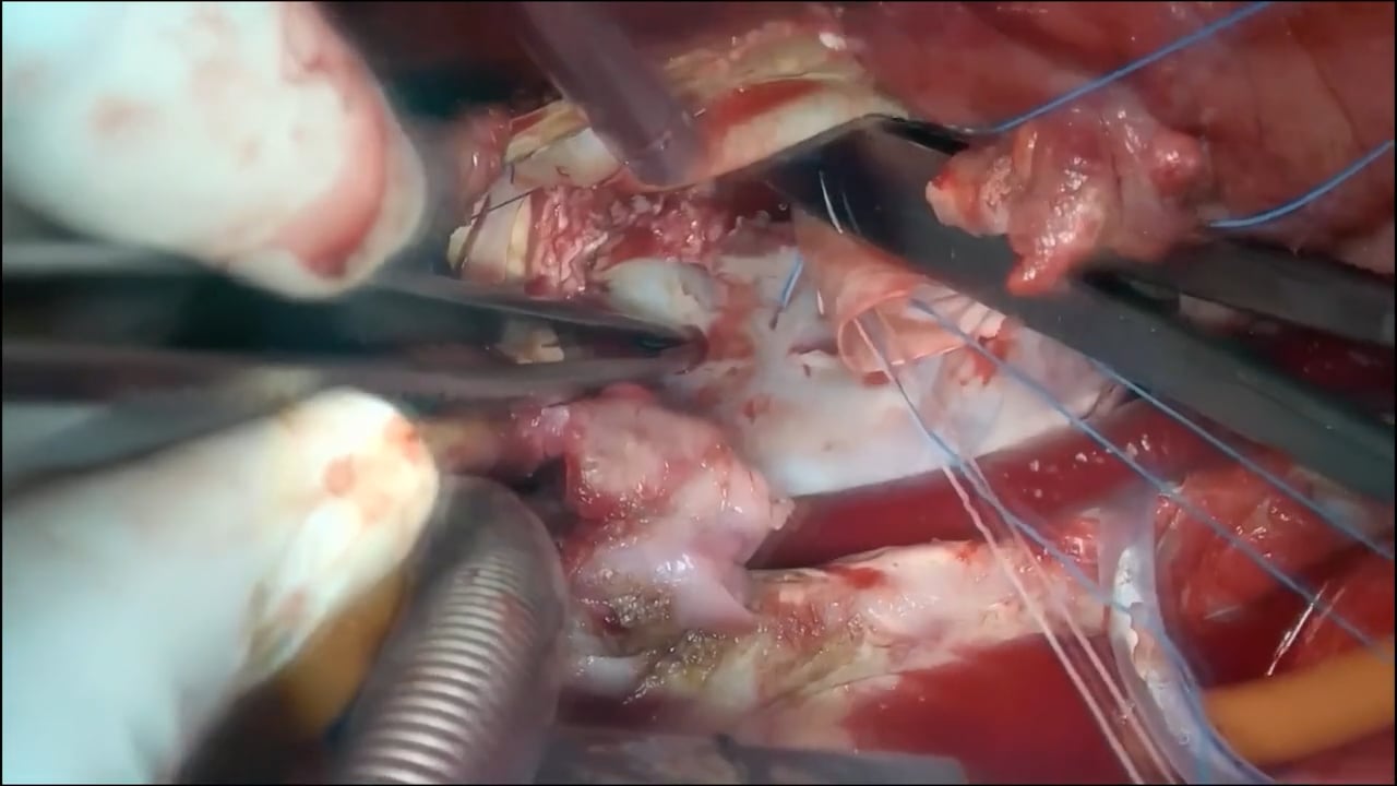 Commando procedure with posterior atrioventricular groove ...