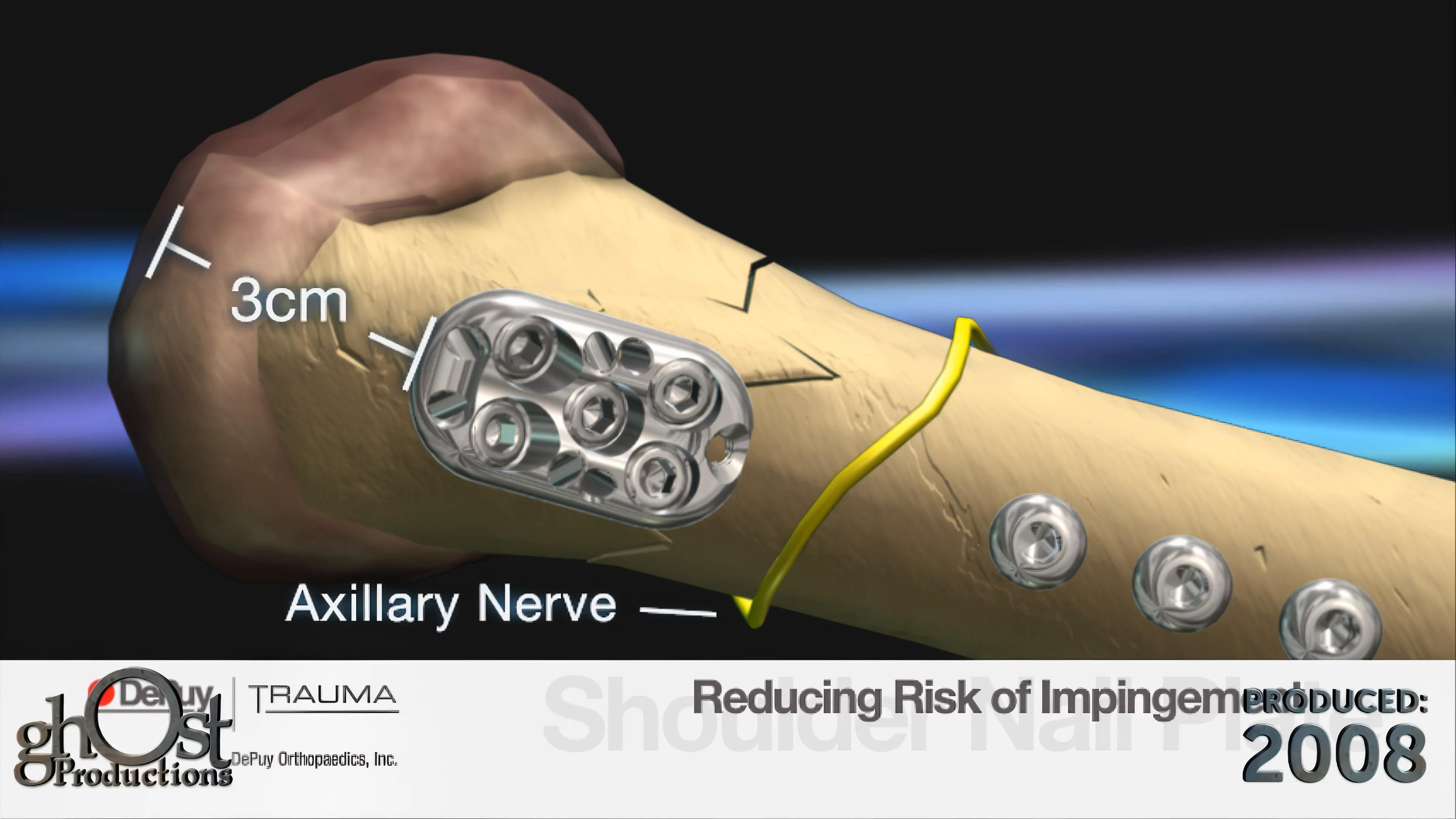 Depuy S3SNP 08 Shoulder Nail Plate System on Vimeo