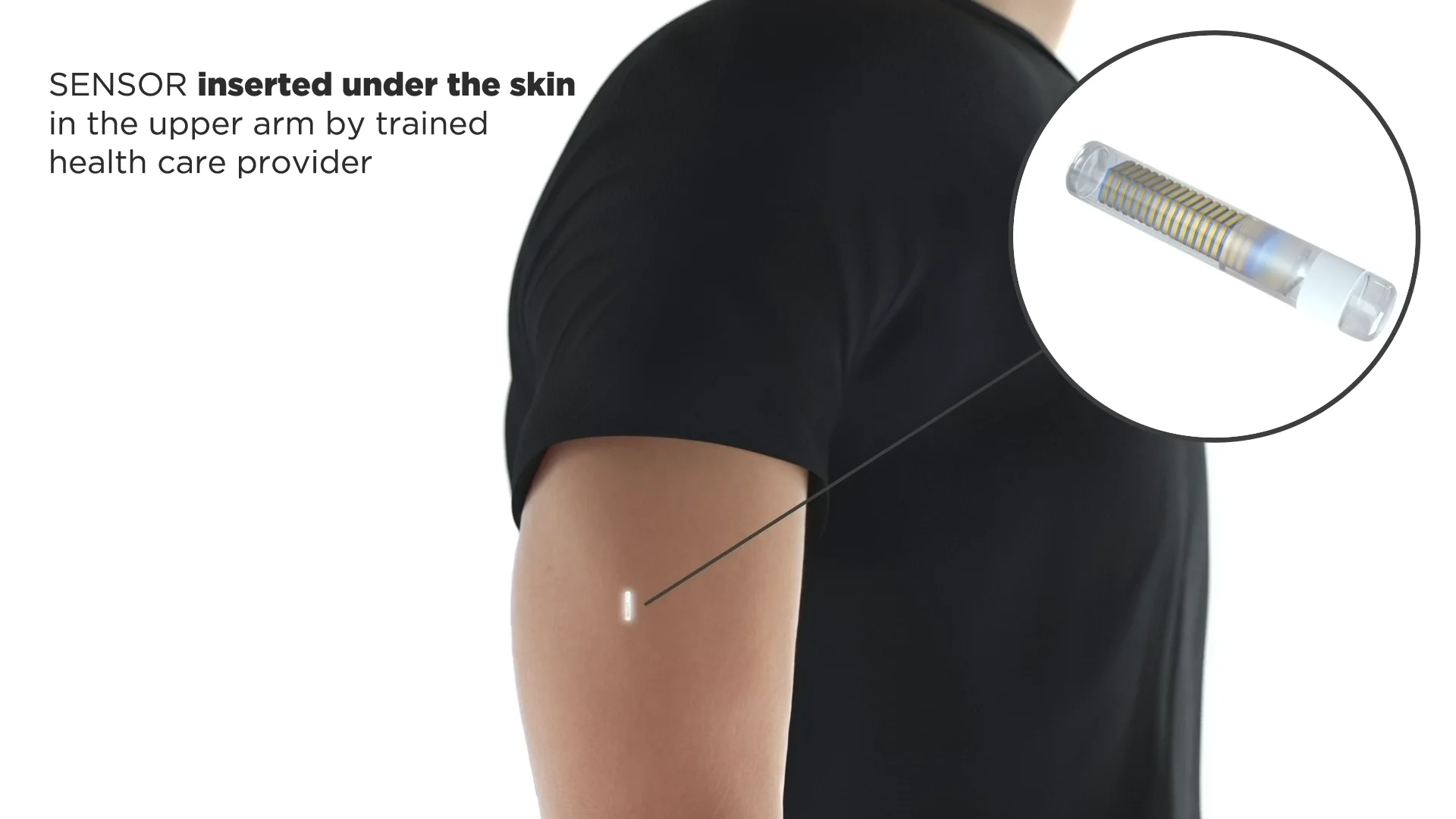 Eversense E3 CGM – How it Works