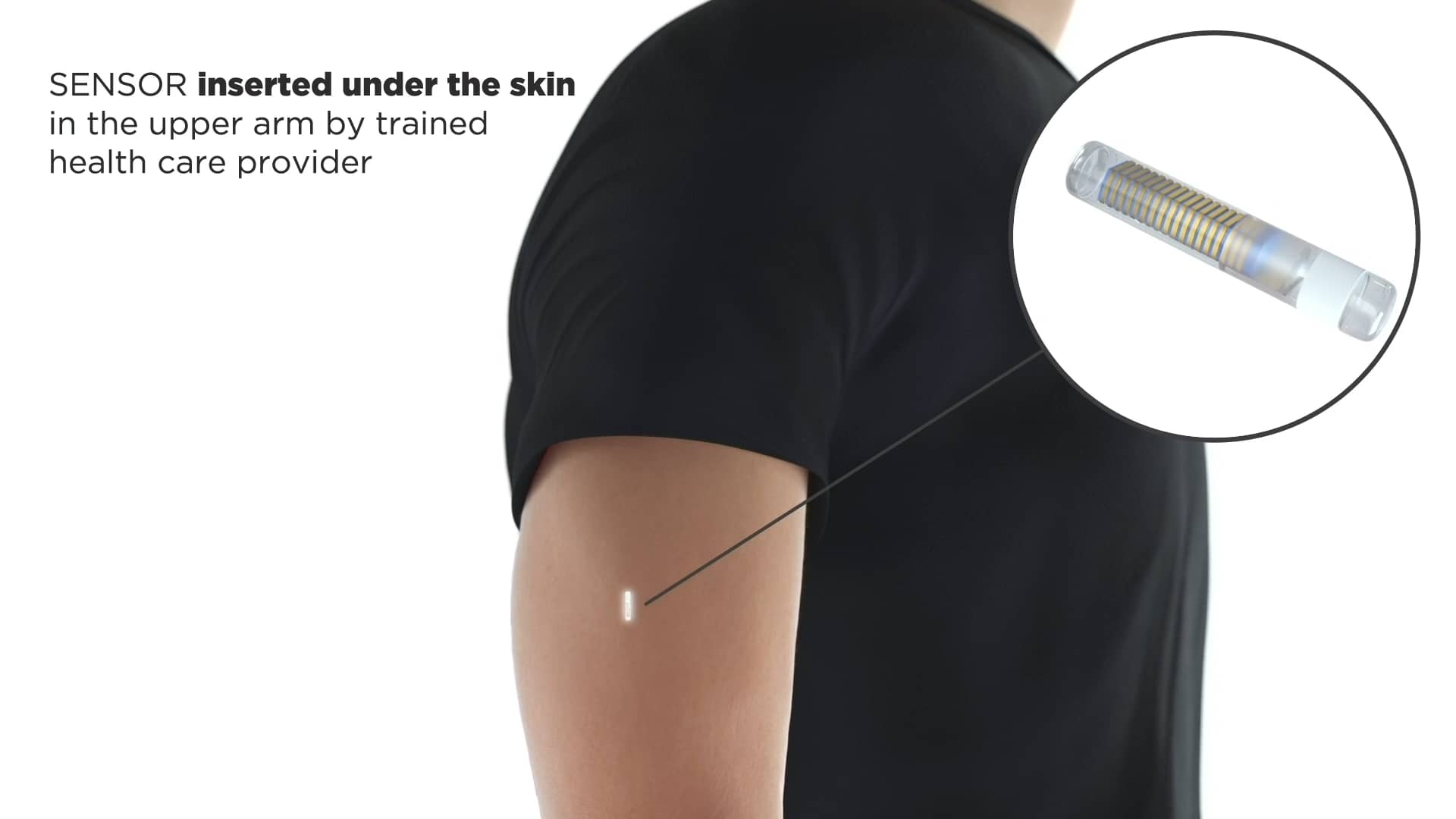 Eversense E3 CGM – How it Works on Vimeo