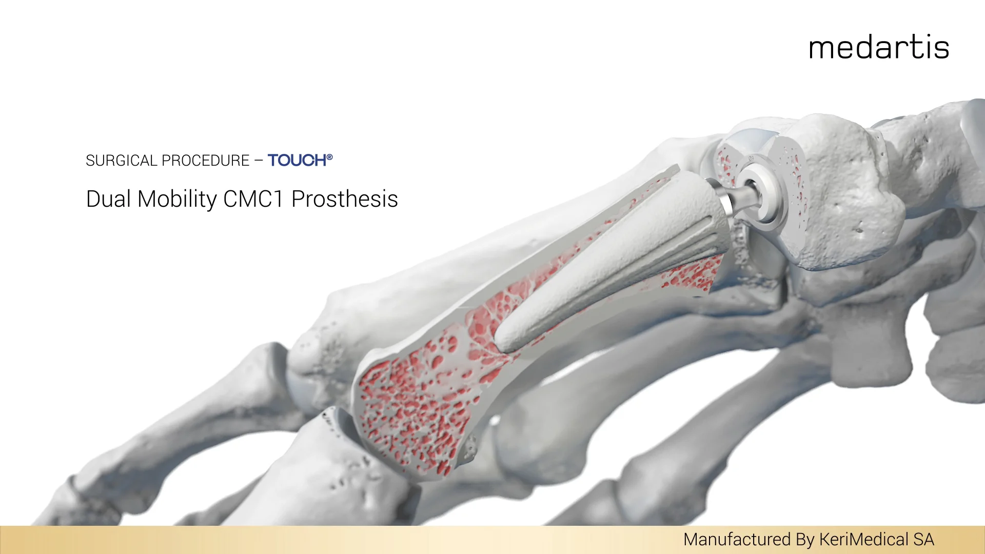 TOUCH® Surgical Procedure