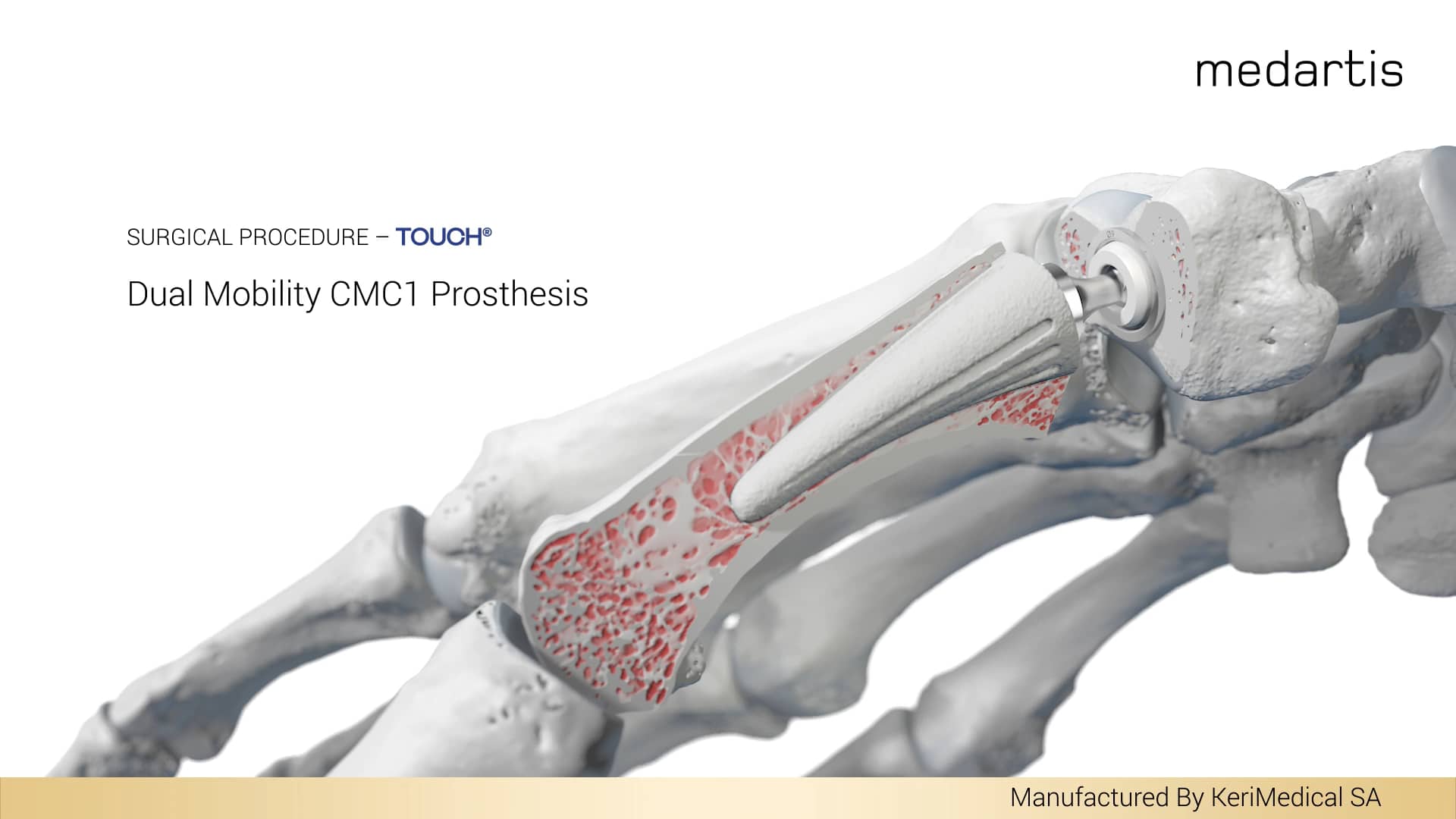 TOUCH® Surgical Procedure on Vimeo