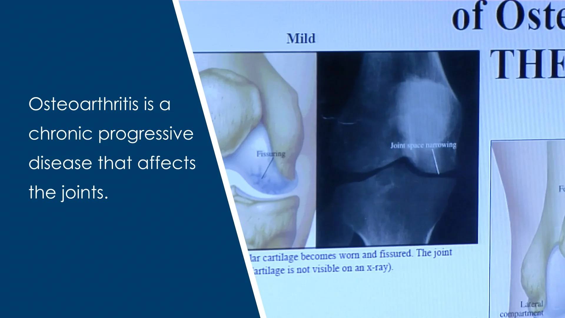 SCRMC HealthBreak | Osteoarthritis Promo on Vimeo