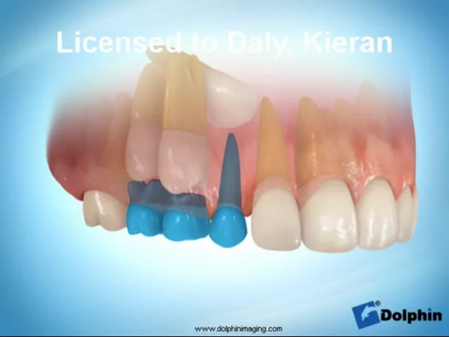 Maxillary Deciduous Canine Extraction (Mixed Dentition) on Vimeo