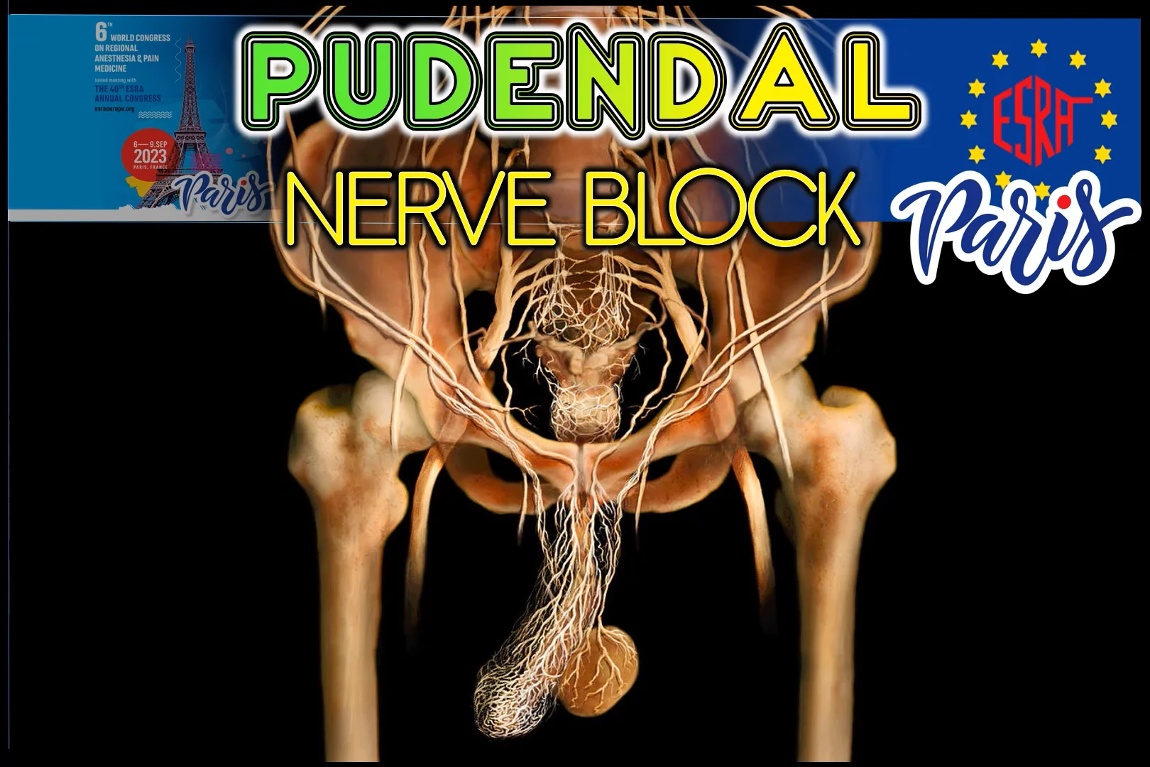 Ultrasound Guided Pudendal Nerve Block, by Vicente Roqués