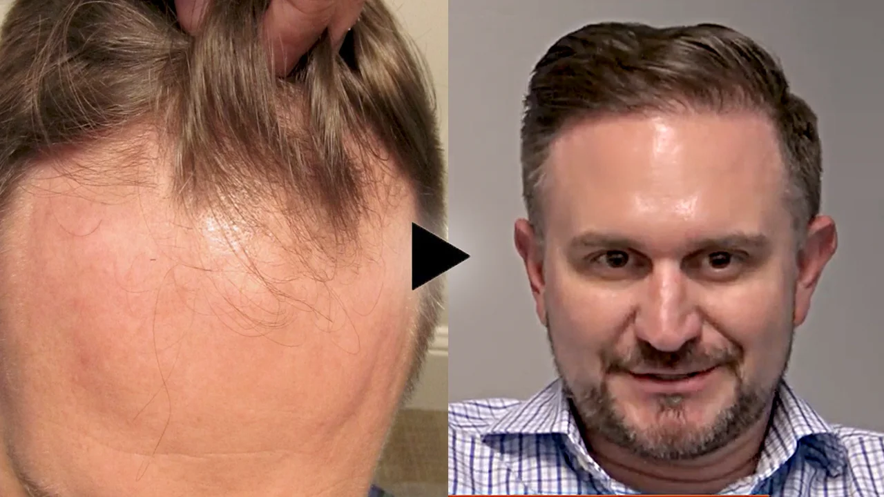 Frontal Hairline Reconstruction - Before and After on Vimeo