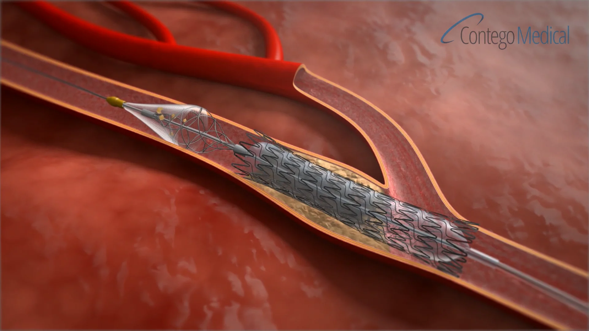 The Neuroguard IEP System: Smarter, Safer Carotid Stenting
