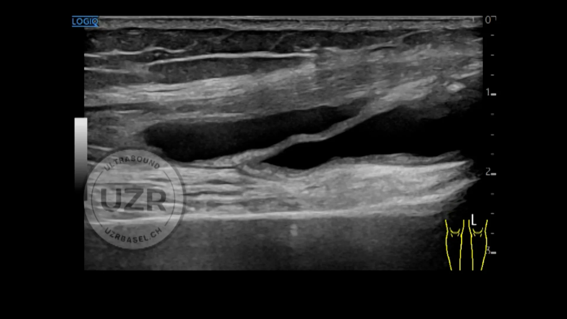 Musculoskeletal Ultrasound - Knee - Synovial Plica on Vimeo
