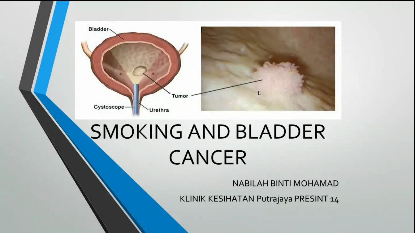 SMOKING AND BLADDER CANCER on Vimeo