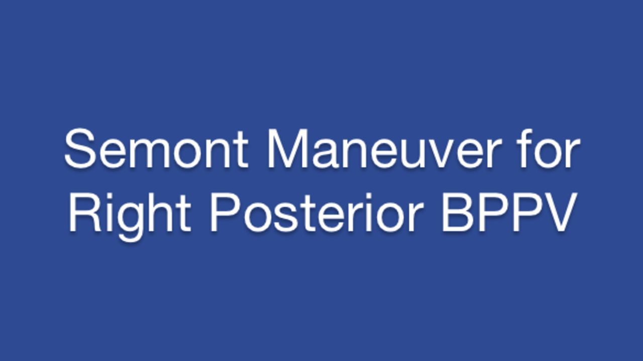 Semont Maneuver for Right Posterior BPPV on Vimeo