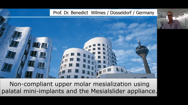 Webinar on non-compliant molar mesialization, mini-implants