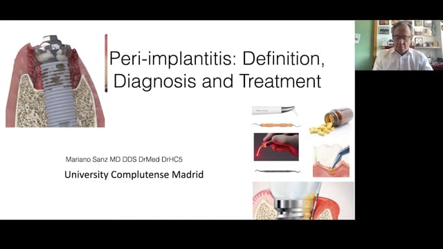 Webinar on peri-implantitis, prosthetic restoration design